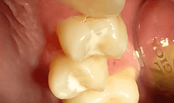 Selante de Fóssulas e Fissuras - Sorriso e Saúde . Net